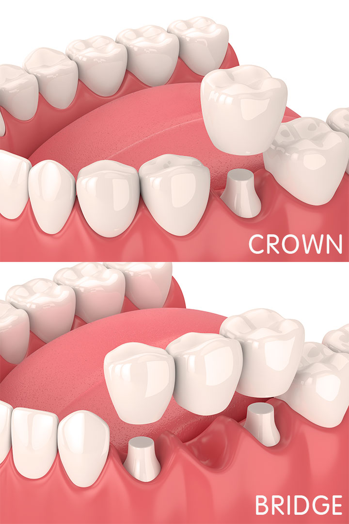 Crowns and Bridges - Luminous Dental Group